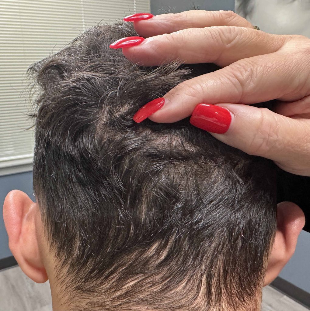 Plastic Surgery Case Study - Custom Skull Implant for the Flat ...