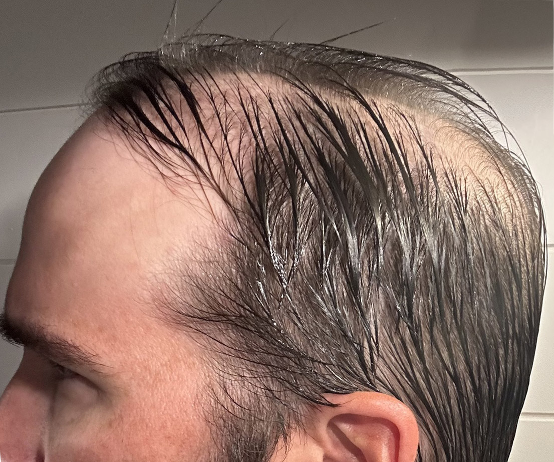 male boen cement skull reconstruction side view Dr Barry Eppley ...