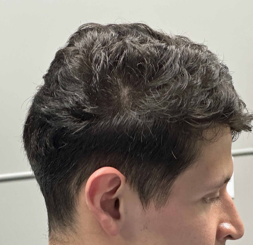 Plastic Surgery Case Study - Custom Skull Implant for the Flat ...