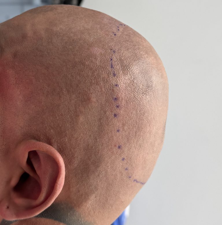 male custom back of head skull implanmt intraop side 1 Dr Barry Eppley ...