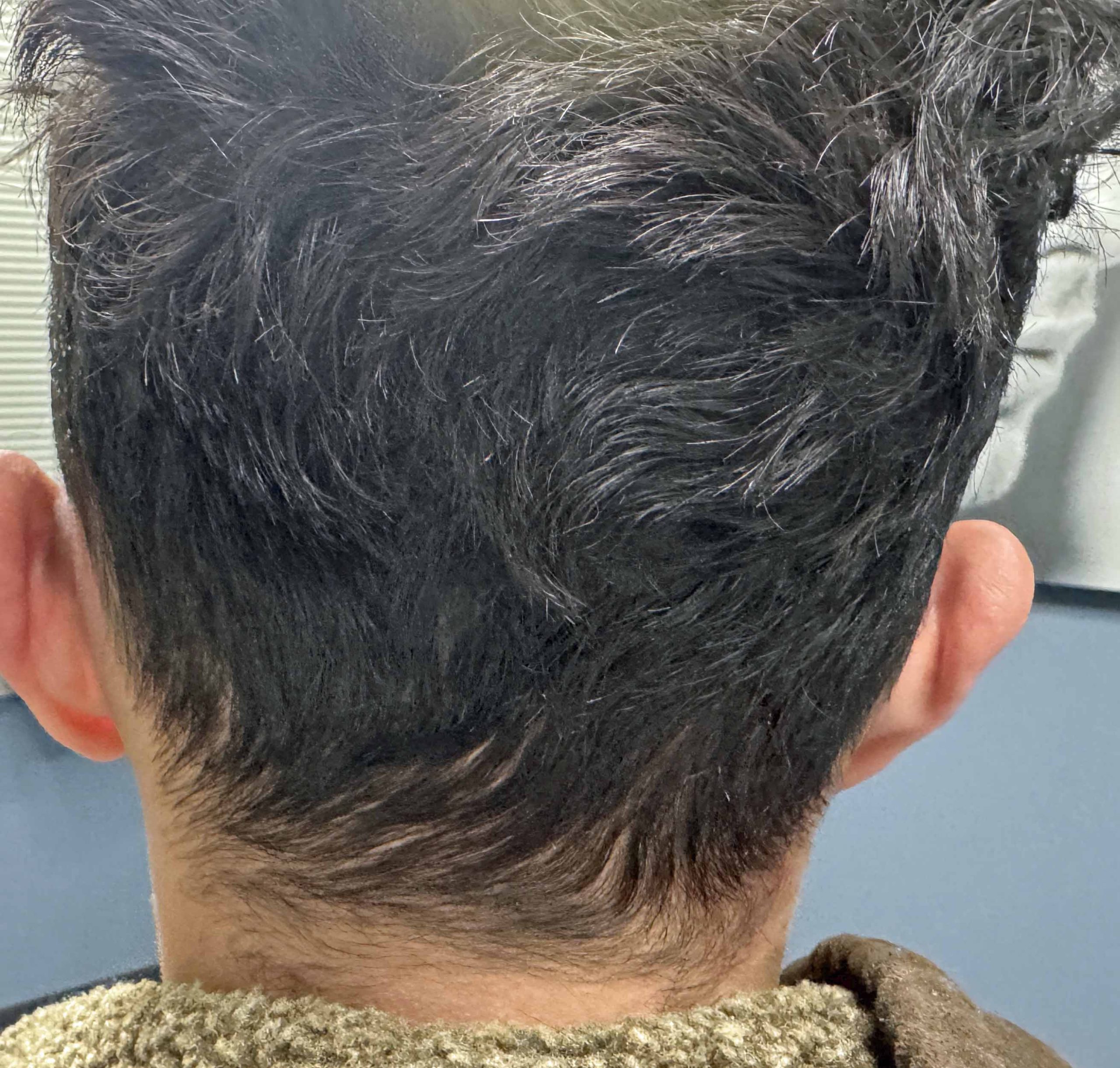 male custom back of head skull implant incision Dr Barry Eppley ...