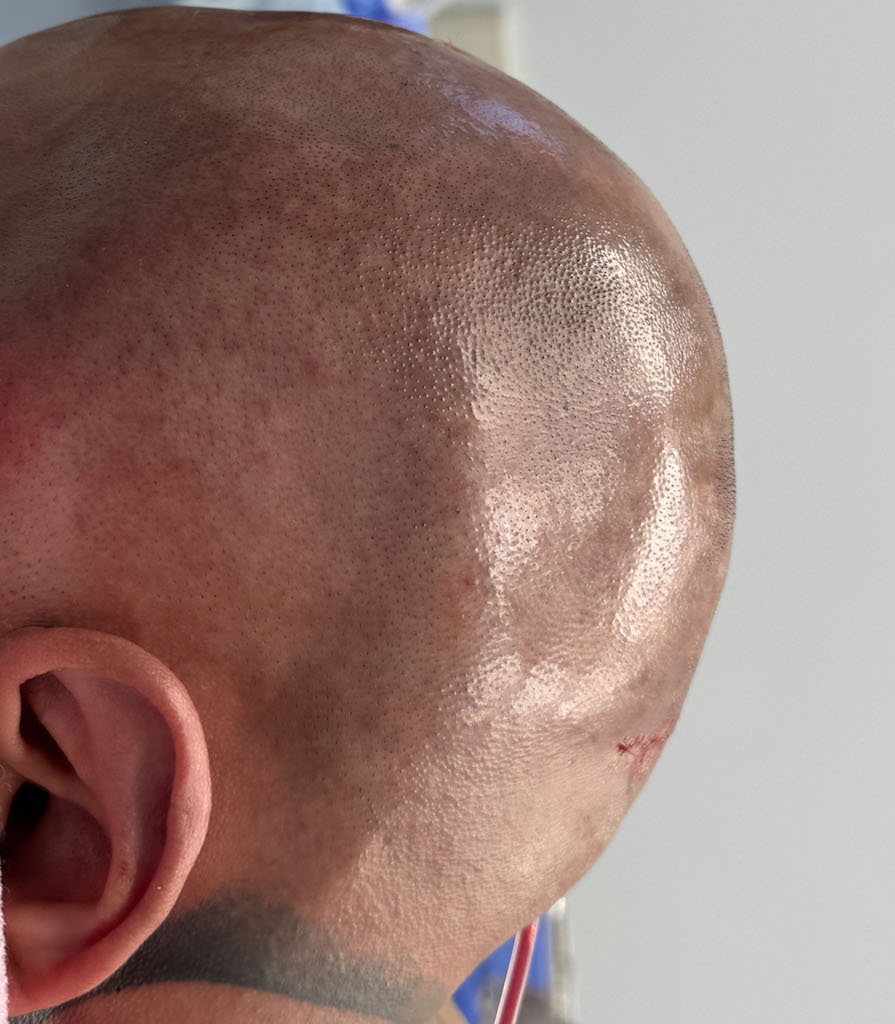 Plastic Surgery Case Study - Custom Back of Head Skull Implant As Part ...