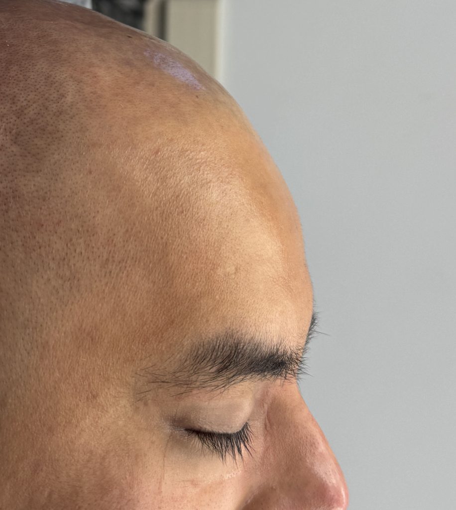 Plastic Surgery Case Study - Male Custom Forehead Implant Augmentation ...