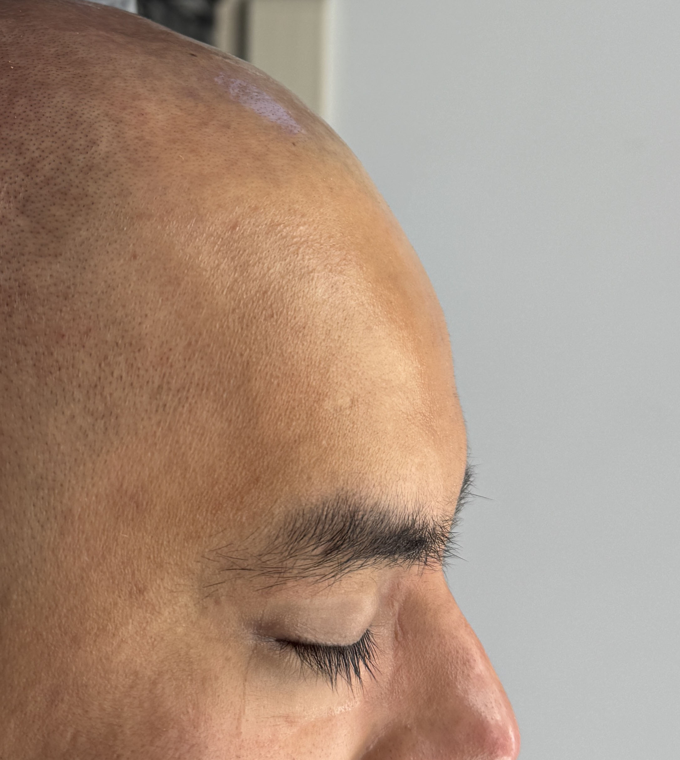 male custom forehead implant intraop side 1 Dr Barry Eppley - Explore ...