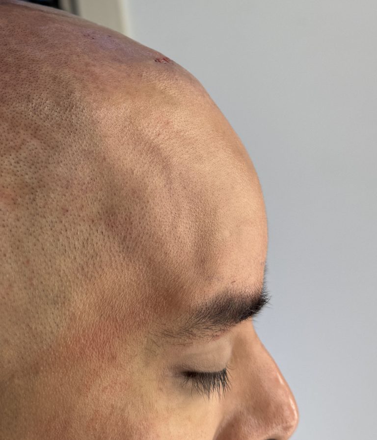 Plastic Surgery Case Study - Male Custom Forehead Implant Augmentation ...