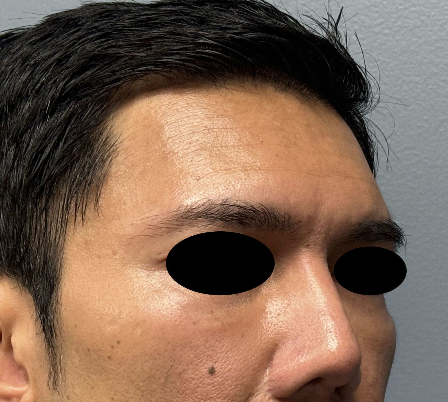 male custom forehead implant oblique 1cropped Dr Barry Eppley 2 ...