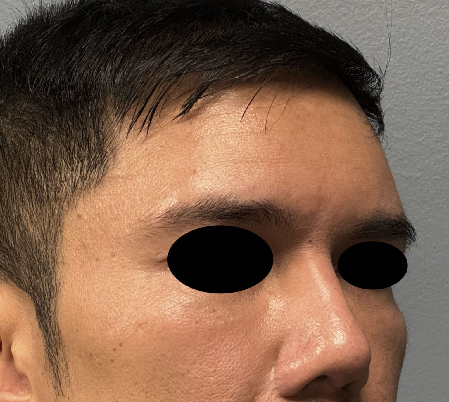 male custom forehead implant oblique 2cropped Dr Barry Eppley 2 ...