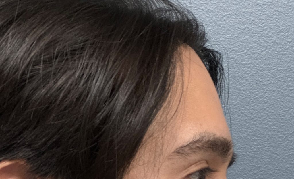 Plastic Surgery Case Study - Male Custom Forehead -Brow Bone Implant ...