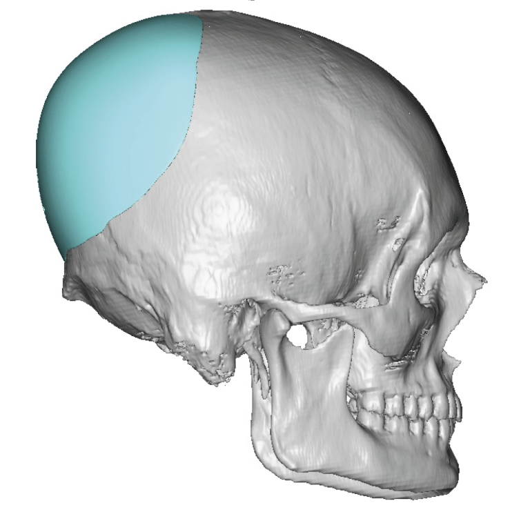 male flat back of head custom skull implant Dr Barry Eppley - Explore ...