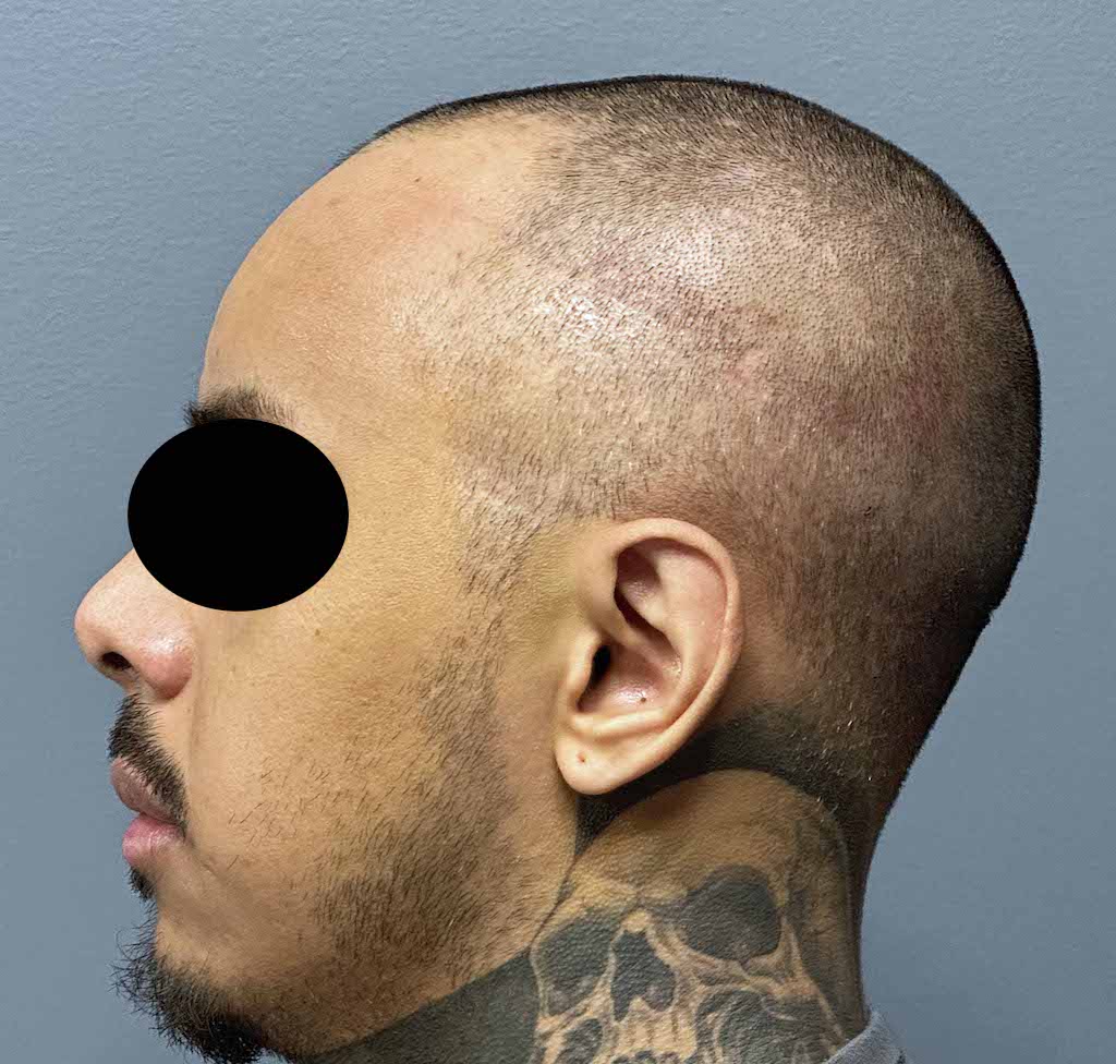 male front and back of head skull implants resuolt left side copy ...