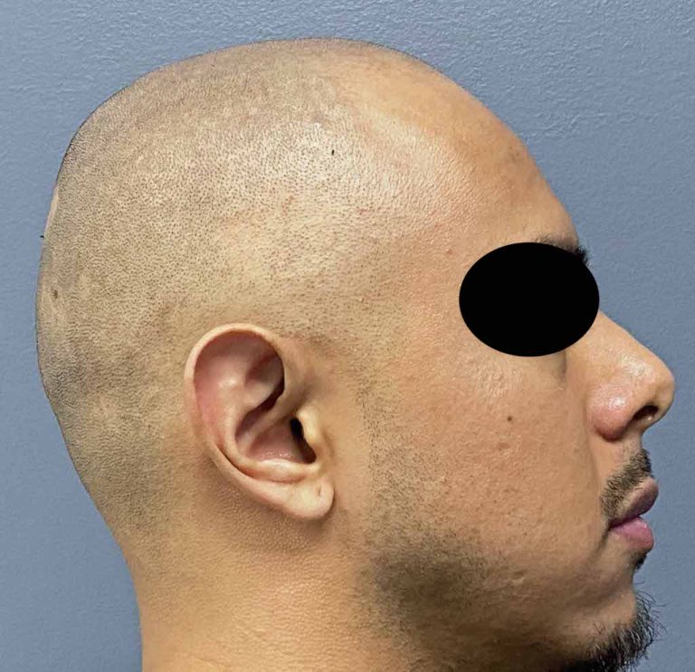 Plastic Surgery Case Study - Custom Forehead and Back of Head Skull ...