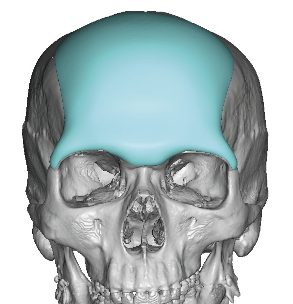 male sloped forehead shape 3D CT scan front view Dr. Barry Eppley ...