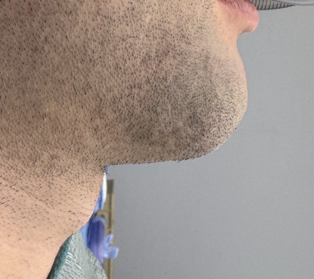 Technical Strategies - Secondary Vertical Chin Lengthening with Implant ...