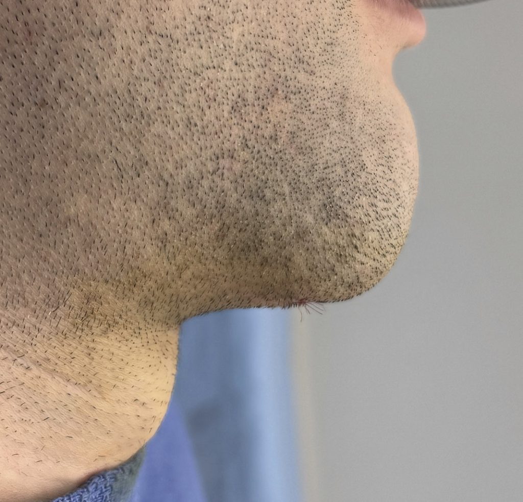 Technical Strategies - Secondary Vertical Chin Lengthening with Implant ...
