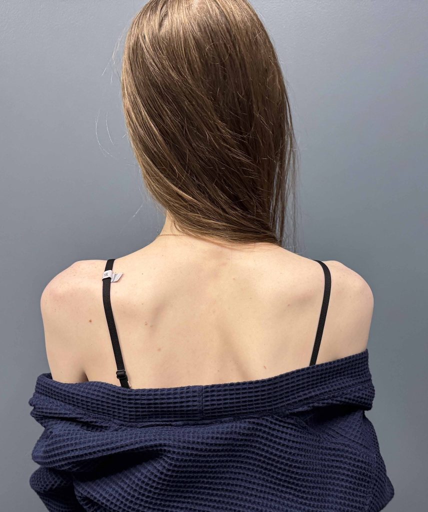 Plastic Surgery Case Study - Evaluating the Shoulder Roll In Effect in ...