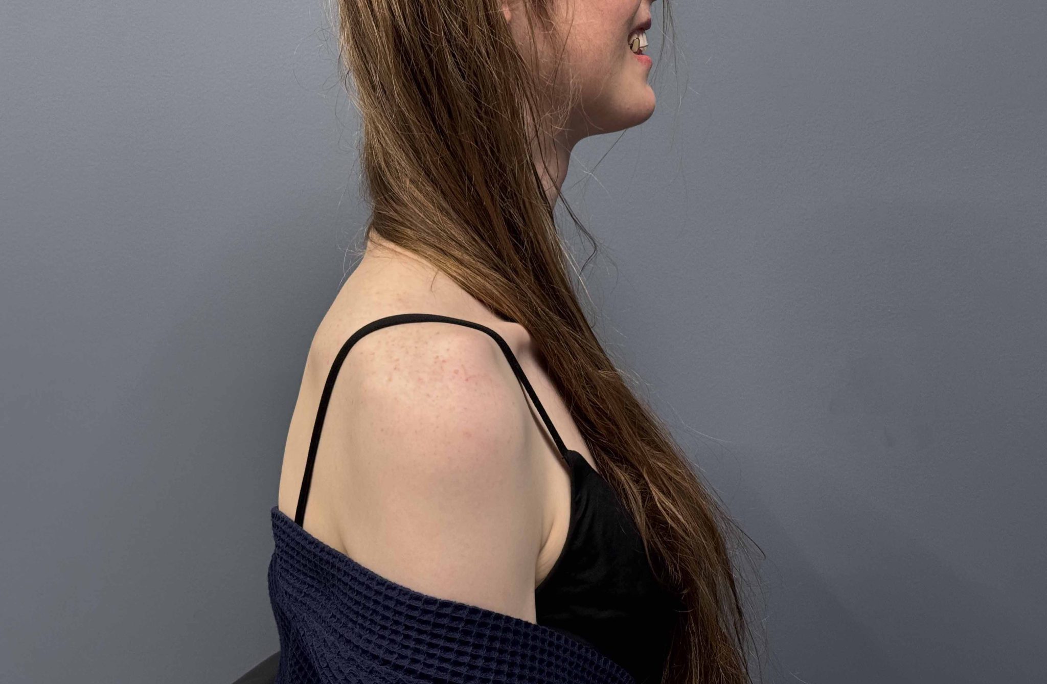 Plastic Surgery Case Study - Evaluating the Shoulder Roll In Effect in ...