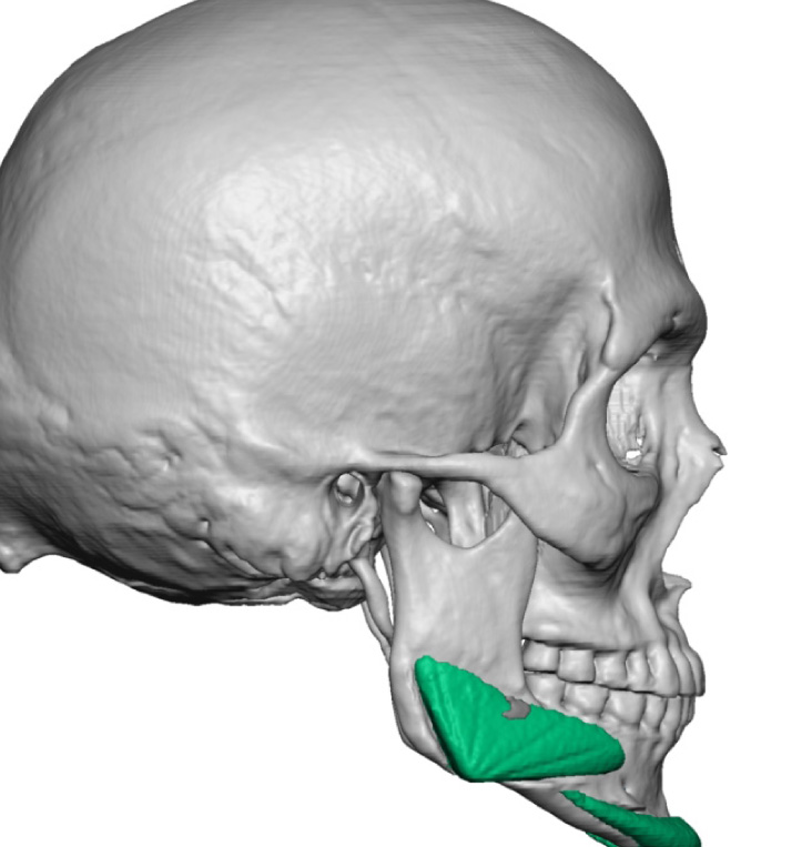 vertical jaw angle implant malposoition Dr Barry Eppley - Explore ...