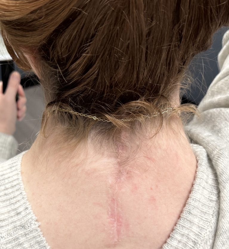 Plastic Surgery Case Study - Secondary Female Webbed Neck Correction ...