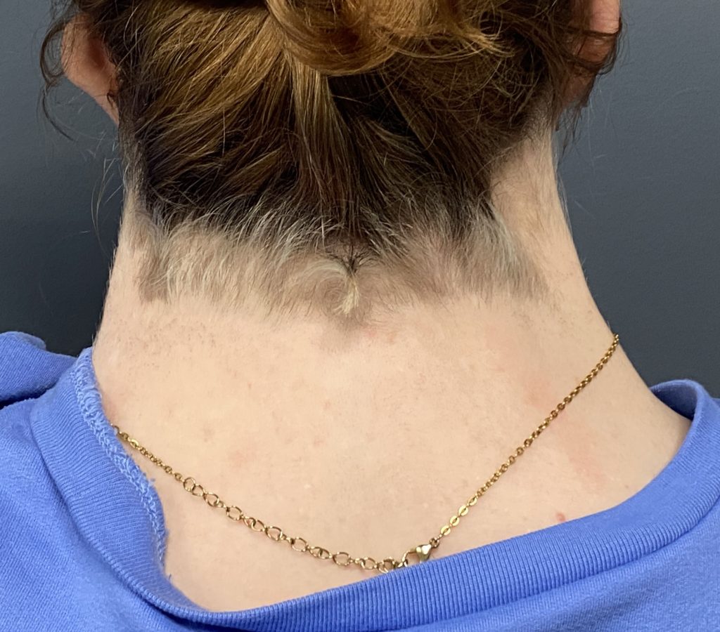 Plastic Surgery Case Study - Secondary Female Webbed Neck Correction ...