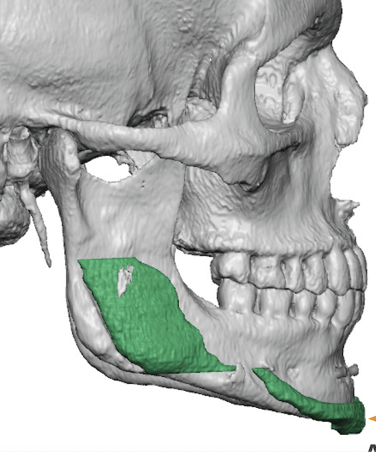 Standard Chin and Jaw Angle Implant Malpositions in Total Jaw ...