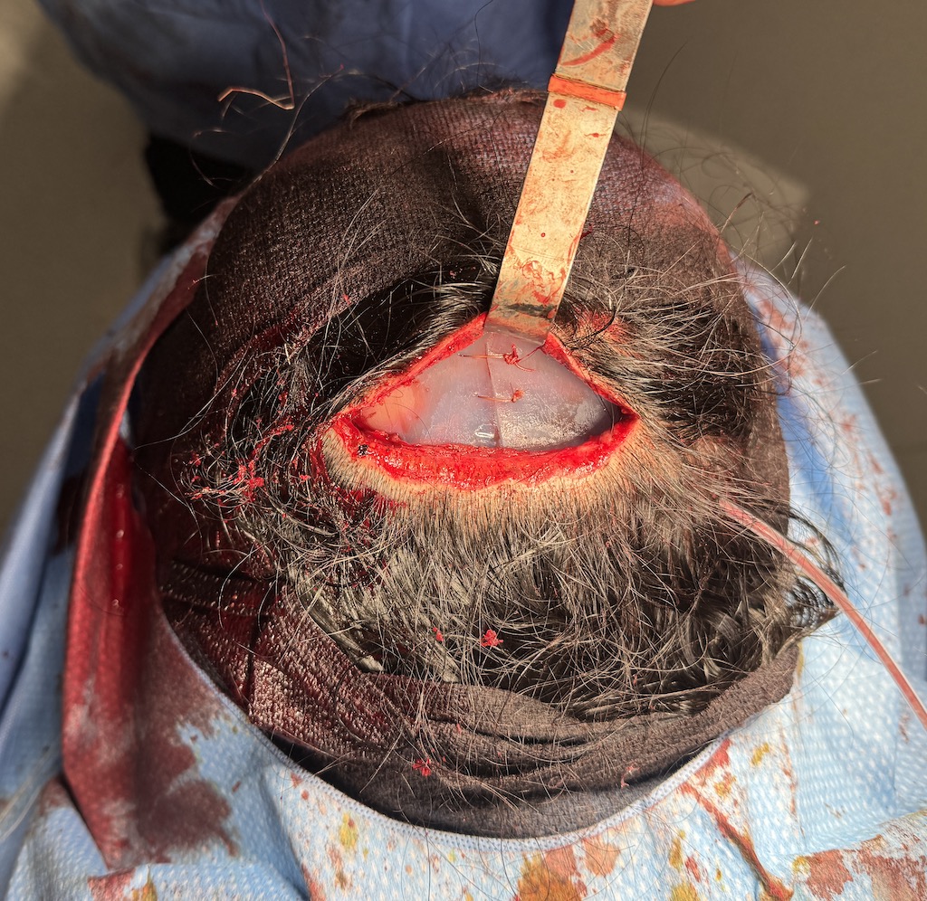 4 oiece custom skull implant placement posterior incision Dr Barry ...