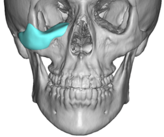 The Seven Layers Of Vertical Orbital Dystopia (VOD) Surgery - Explore ...