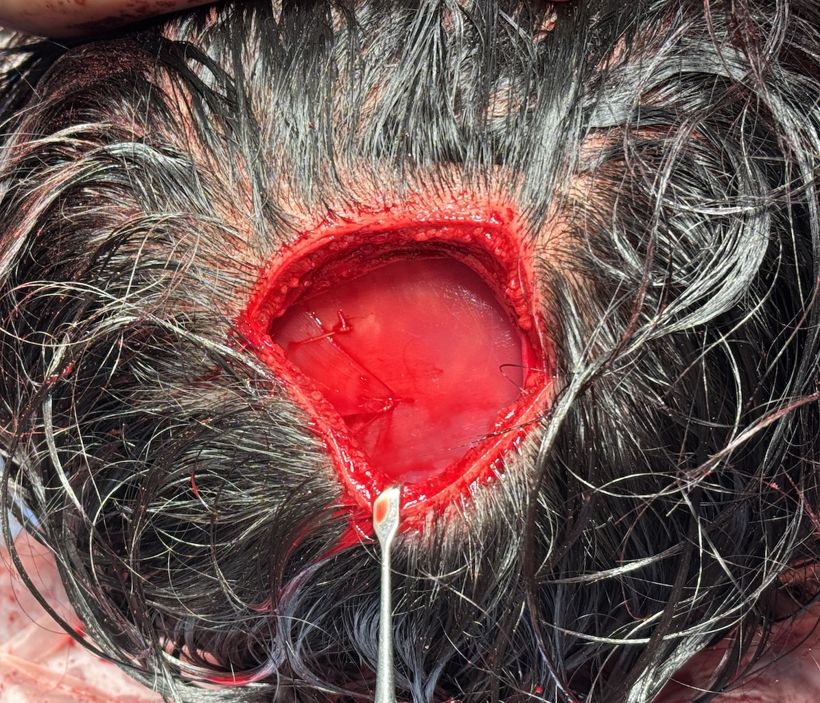 back of head scalp incision for large 4 oiece custom skull implant ...