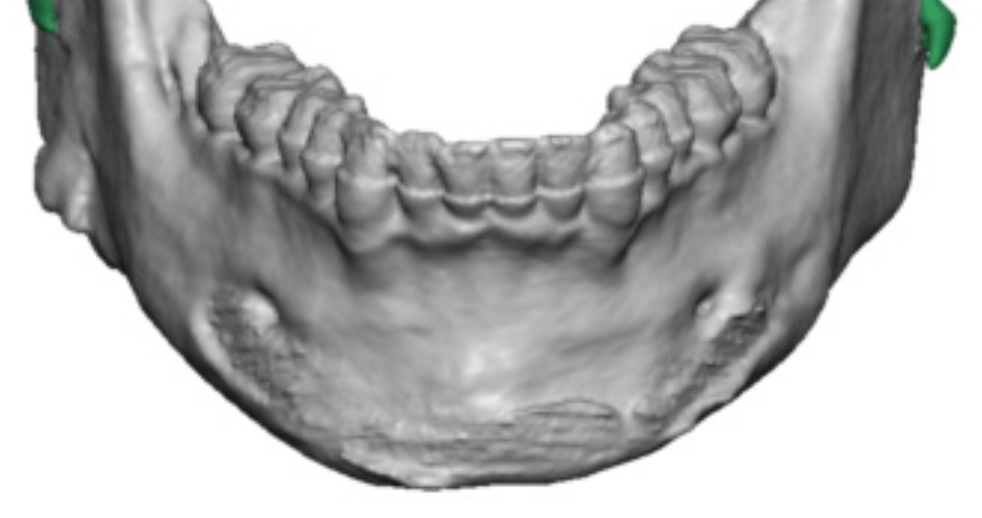 chin and jaw angle implant imprinting 3D CT scan nDr Barry Eppley ...