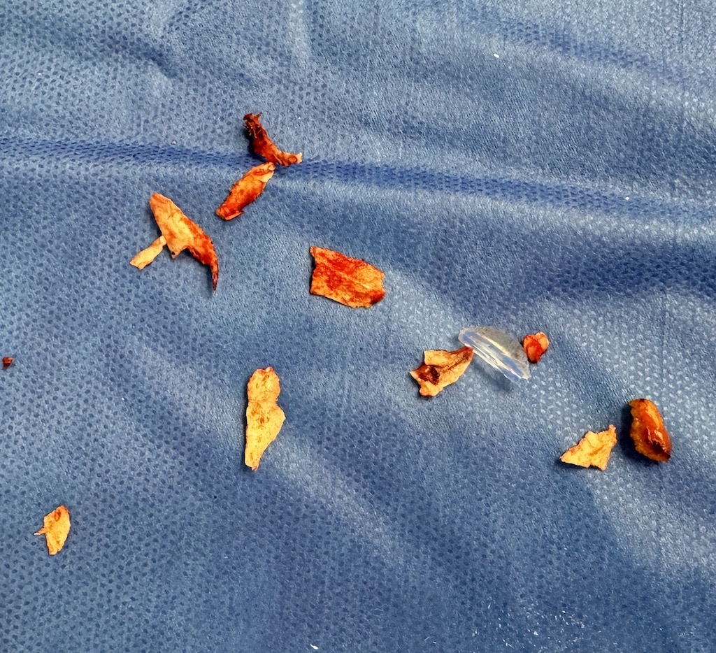 chin implant bone removal Dr Barry Eppley - Explore Plastic Surgery