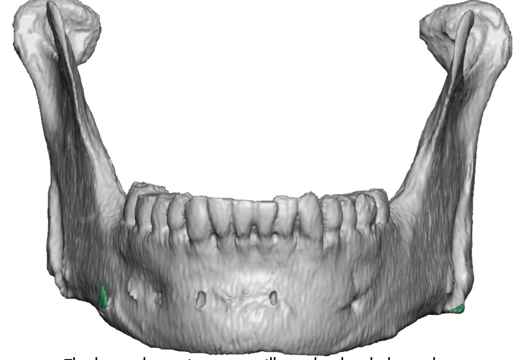 chin implant imprinting 3D CT scan Dr Barry Eppley - Explore Plastic ...