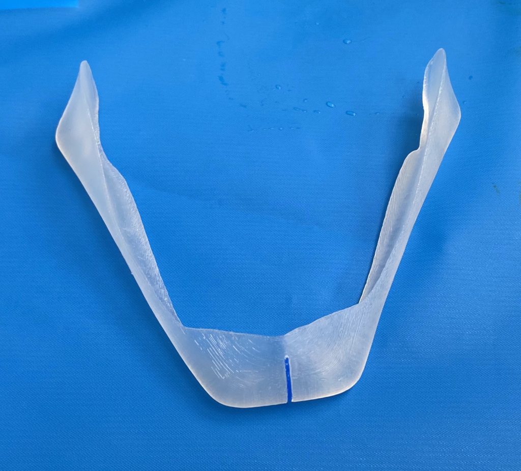 The Submental Incision and Scar From Custom Jawline Implant Placement ...