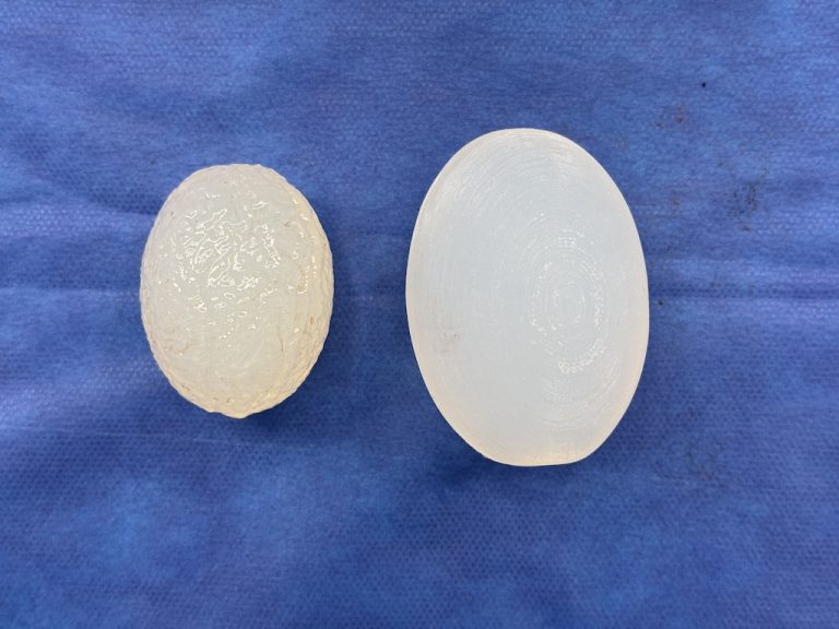 Plastic Surgery Case Study - Left Solid Testicle Implant Replacement ...