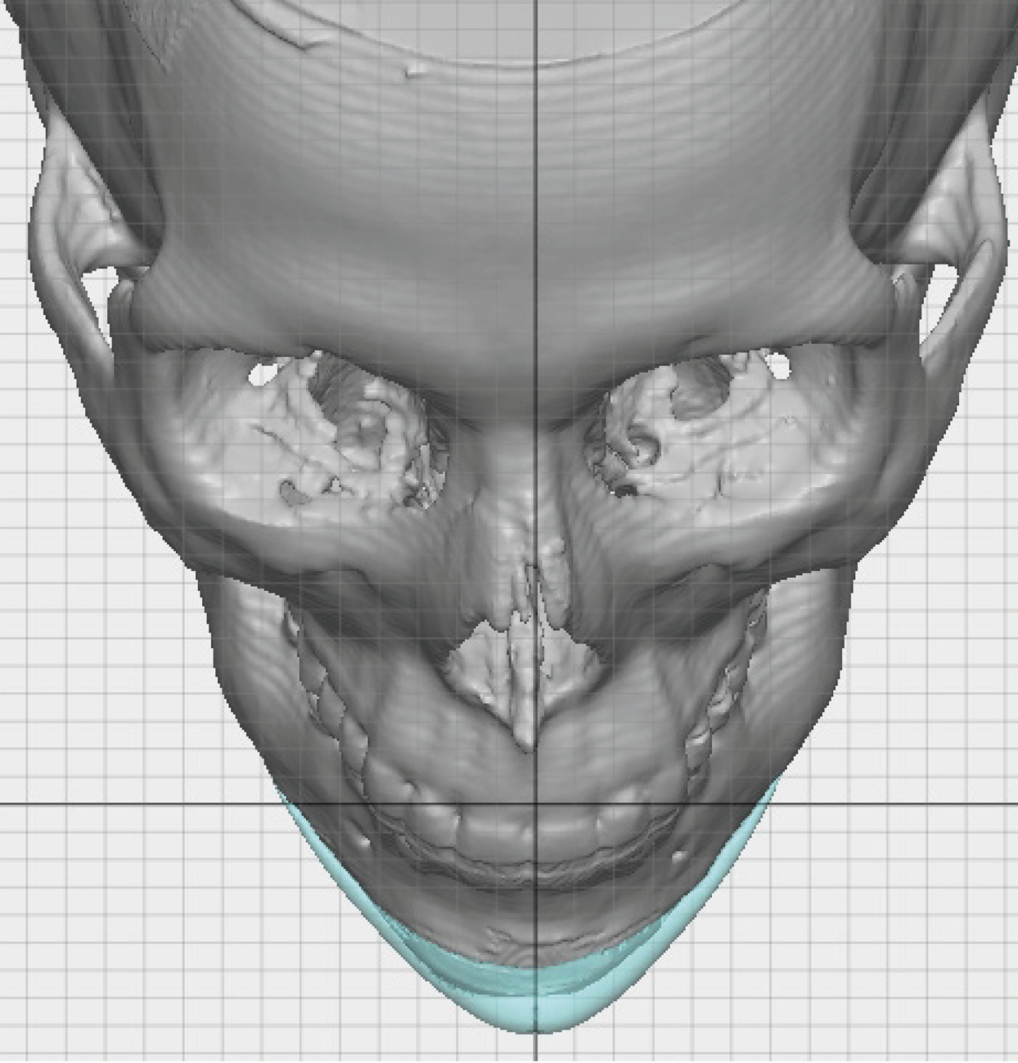 Plastic Surgery Case Study - Tapered Implant Design for Female Chin ...