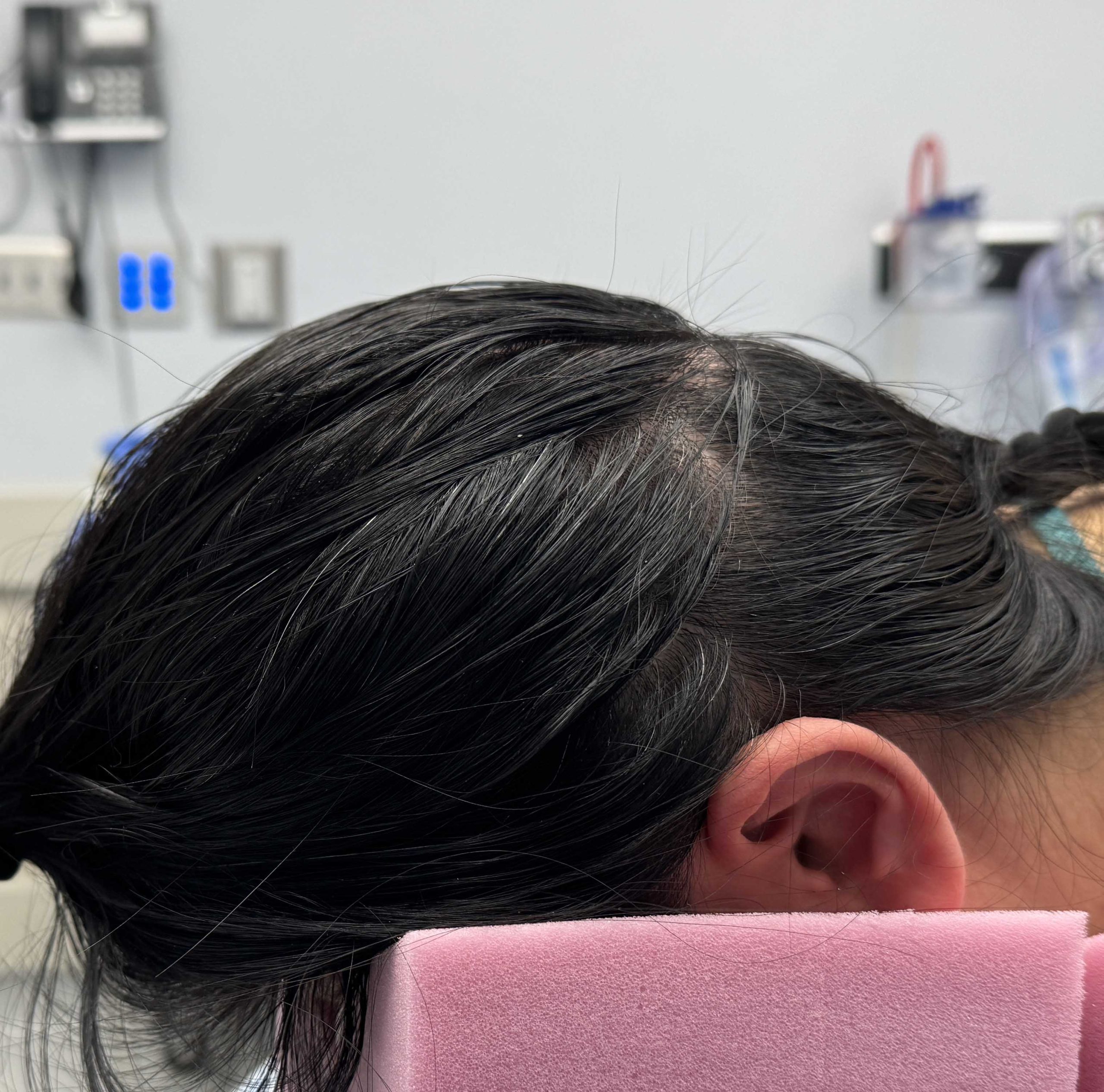 female 1st stage scalp expansion intraop Dr Barry Eppley - Explore ...