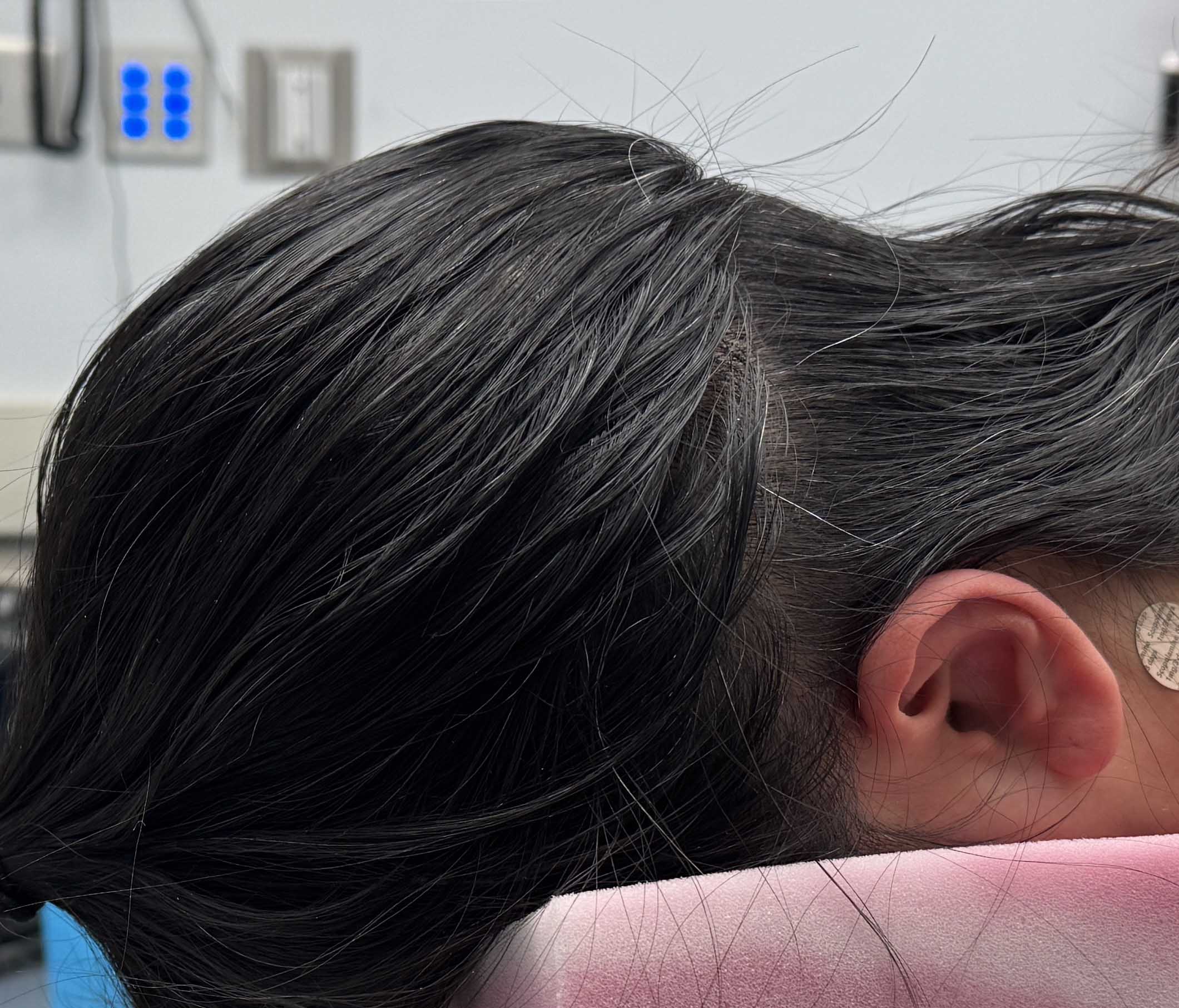 female 2nd stage skull implant Dr Barry Eppley - Explore Plastic Surgery