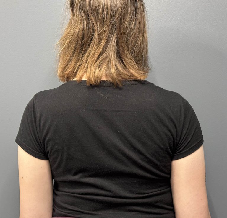 Plastic Surgery Case Study - Shoulder Shape Changes in Tall Female ...