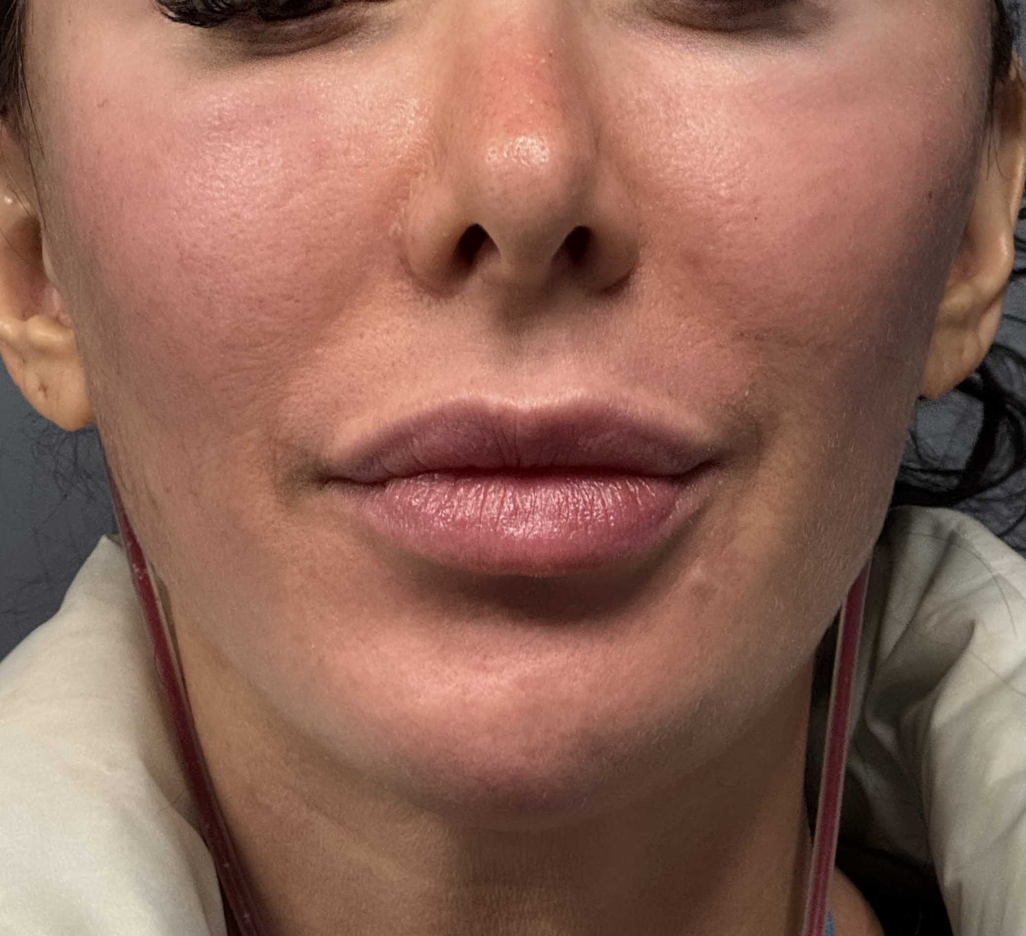 female custom chin front 2 Dr Barry Eppley - Explore Plastic Surgery