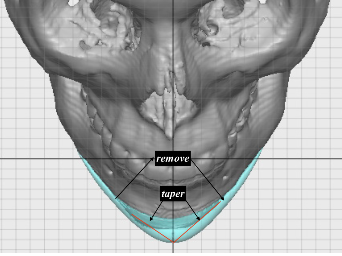 female custom chin implant modifications Dr Barry Eppley - Explore ...