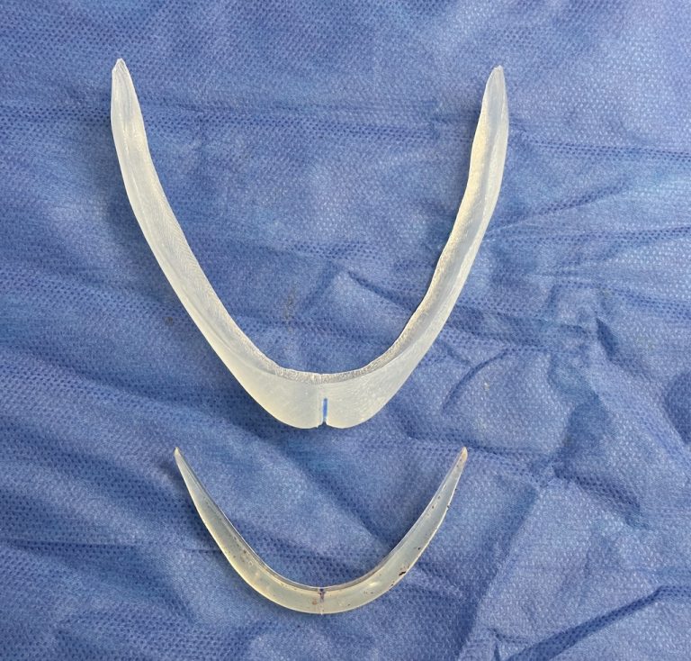 Plastic Surgery Case Study - Female Custom Jawline Implant For Vertical ...