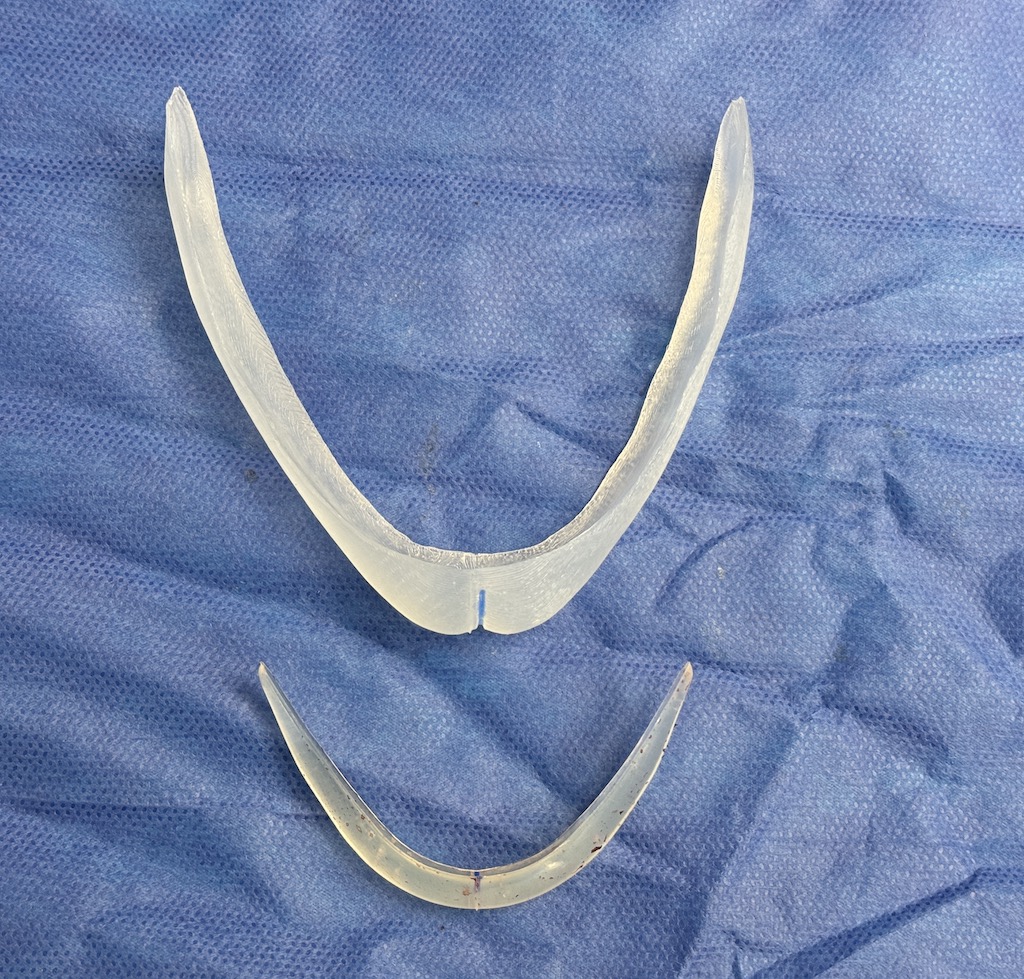 female custom jaewline implant ve chin implant Dr Barry Eppley ...