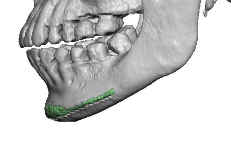 Plastic Surgery Case Study - Female Custom Jawline Implant For Vertical ...