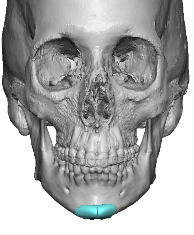 Plastic Surgery Case Study - Tapered Implant Design for Female Chin ...