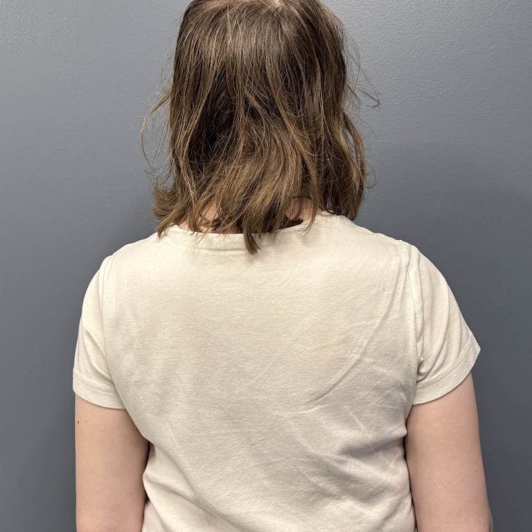 Plastic Surgery Case Study - Shoulder Shape Changes in Tall Female ...