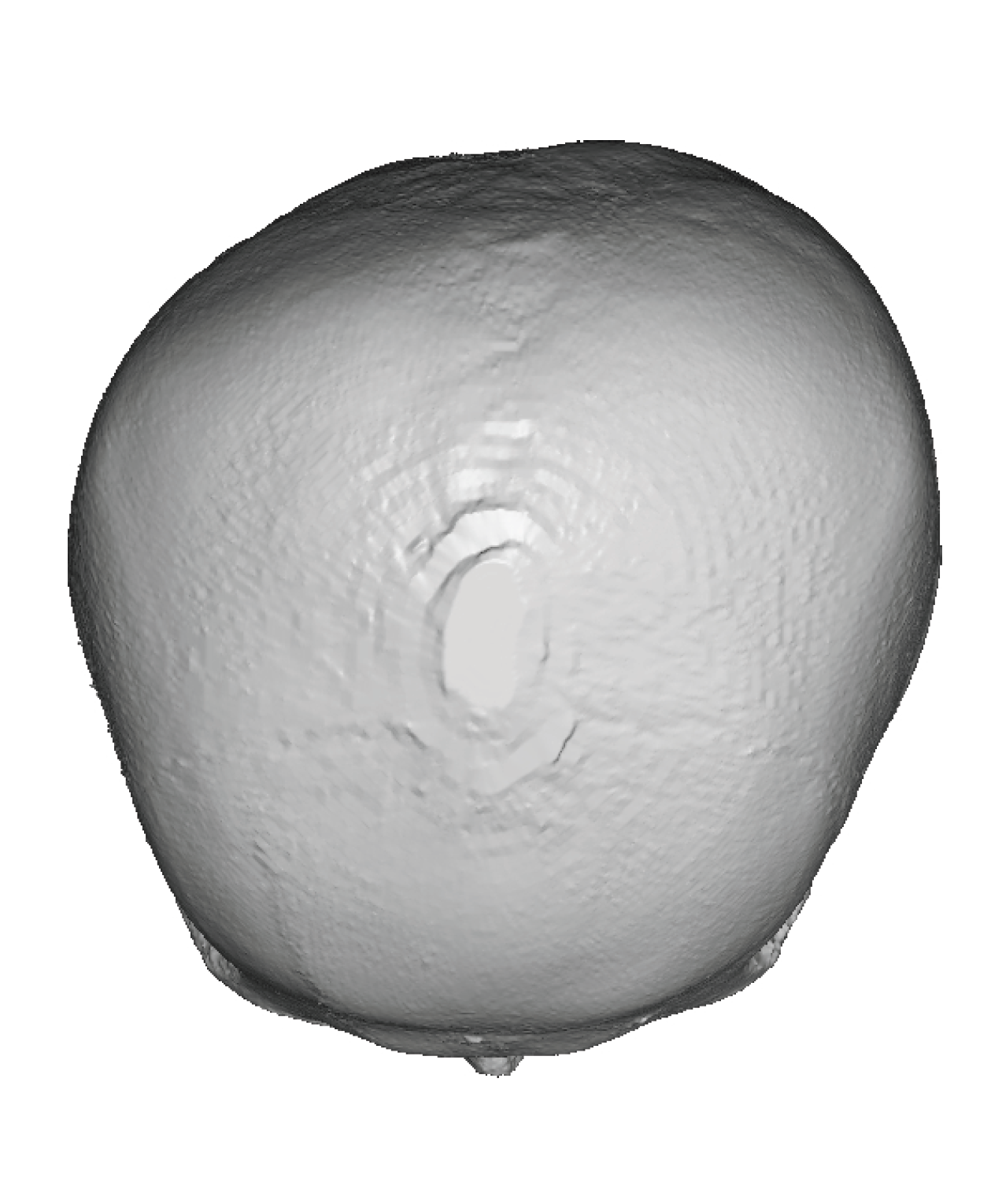 flat back of the head 3D CT scan top view Dr Barry Eppley - Explore ...