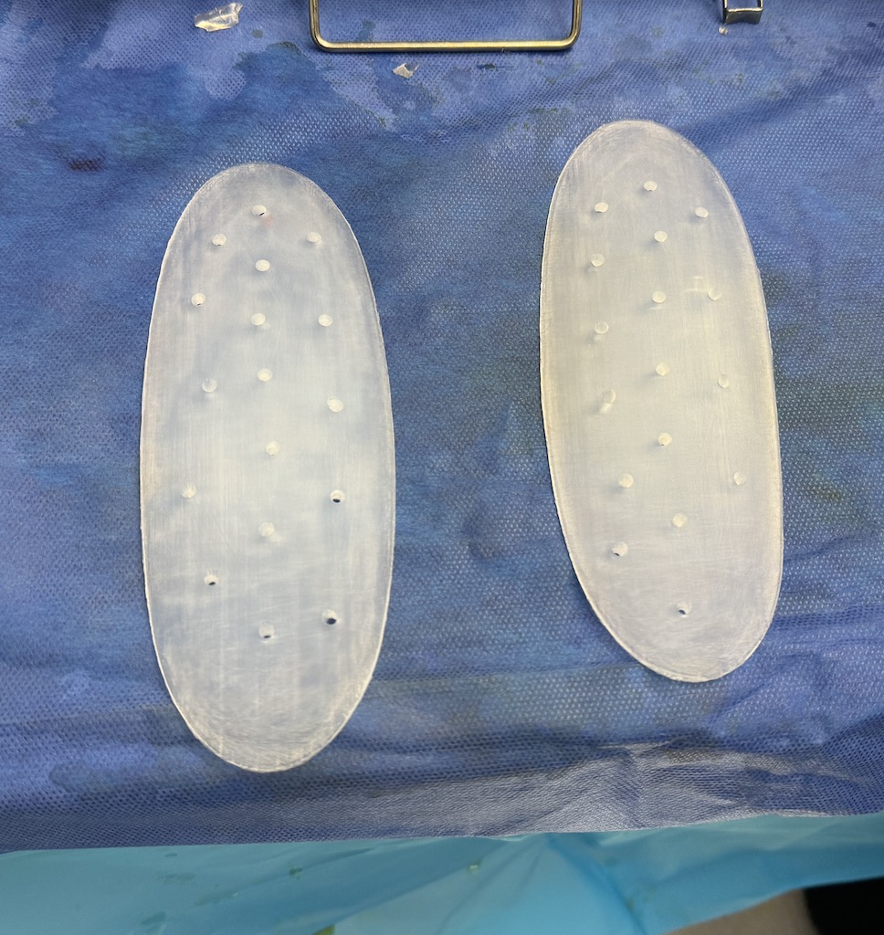 forearm implanbts intraop Dr Barry Eppley - Explore Plastic Surgery