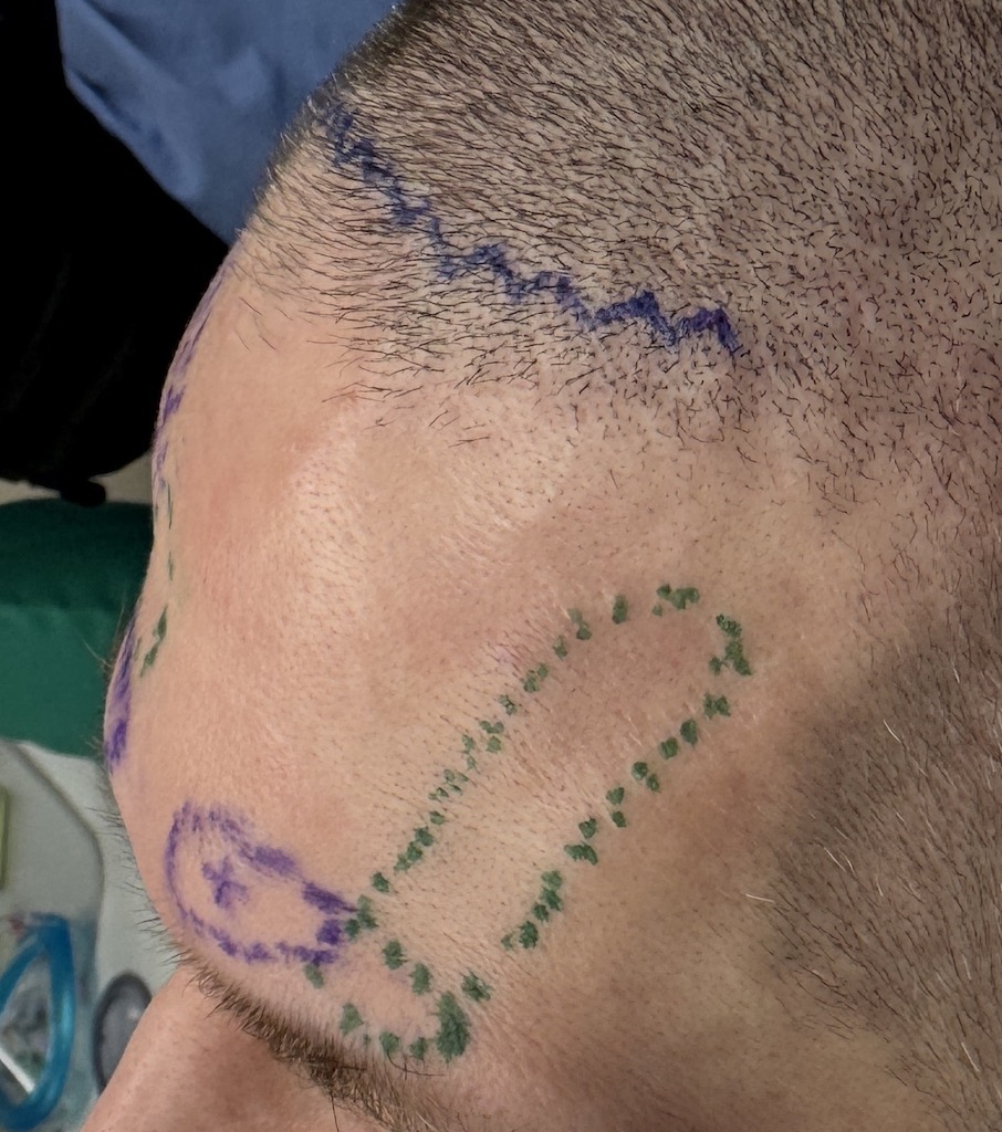 forehead contouring markings side view Dr Barry Eppley - Explore ...