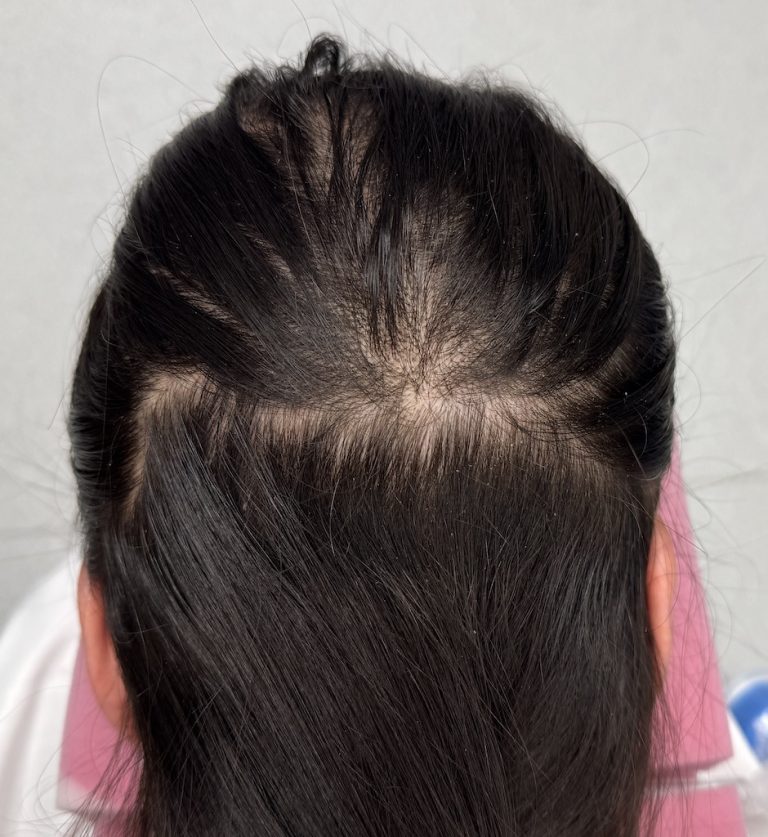 Plastic Surgery Case Study - Two Stage Skull Augmentation for Female ...