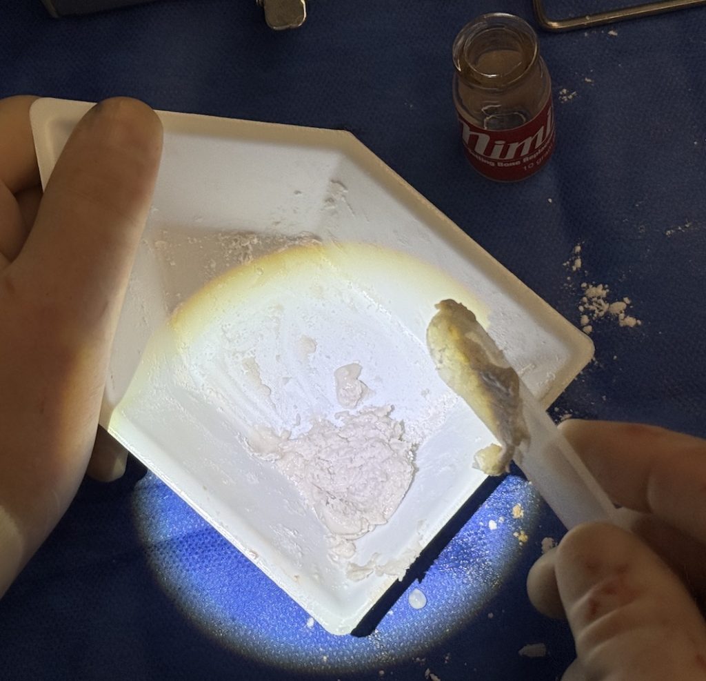 Plastic Surgery Case Study - Male Forehead Contouring Combining Bony ...