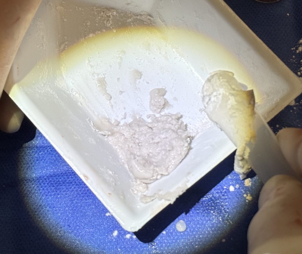 Plastic Surgery Case Study - Combined Sagittal Bump and Parasagittal ...