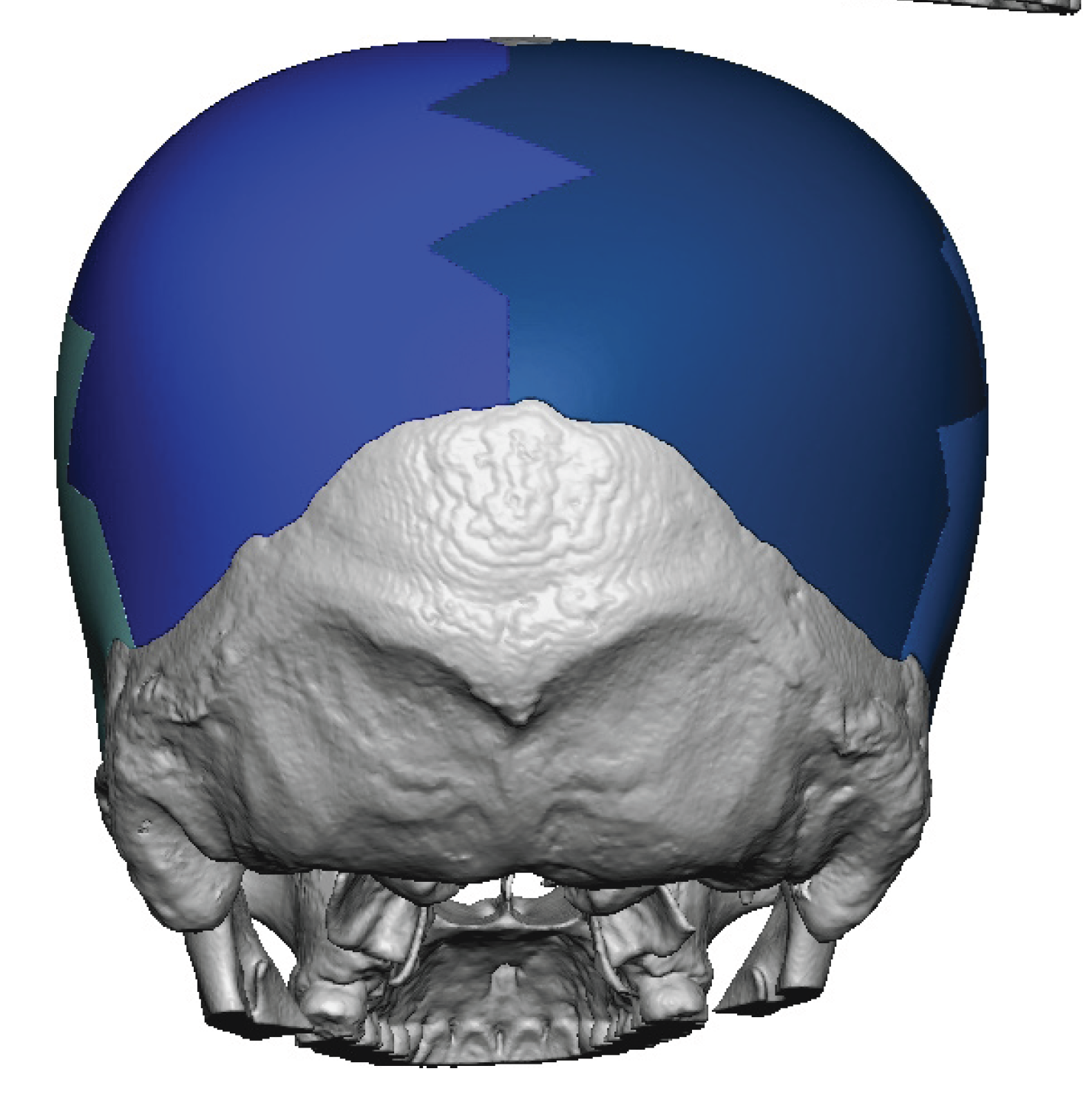 large 4 piece custom head widening imlpant back view Dr Barry Eppley ...